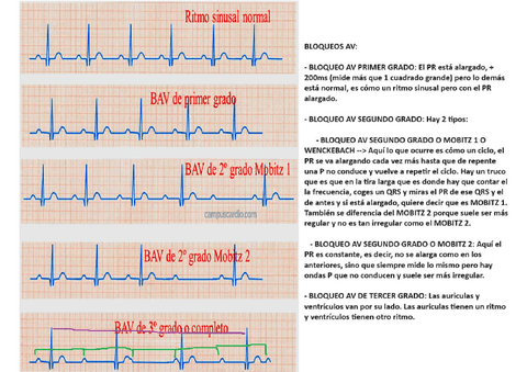 Bloqueo-AV-Esquema.pdf