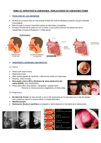 25.1-Hipertrofia-adenoidea.pdf