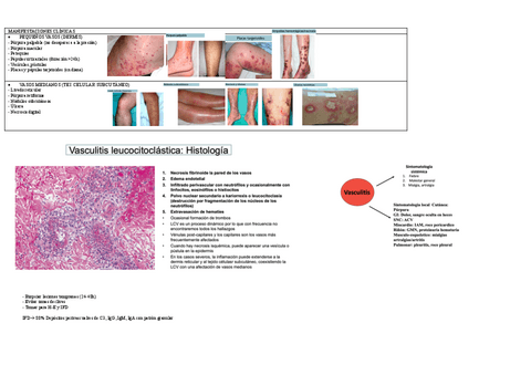 TABLA-VASCULITIS.pdf